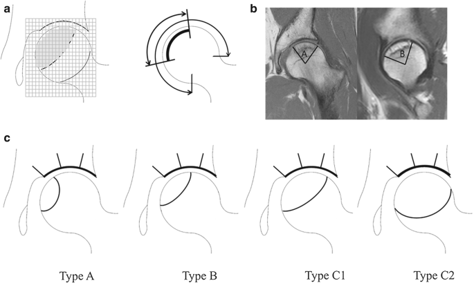 The 2021 Association Research Circulation Osseous Classification for ...