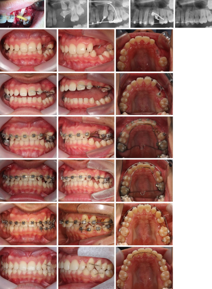 Techniques for Managing Impacted Canine | SpringerLink