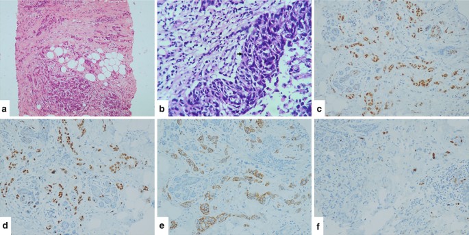 Pathology and Molecular Classification of Breast Cancer | SpringerLink