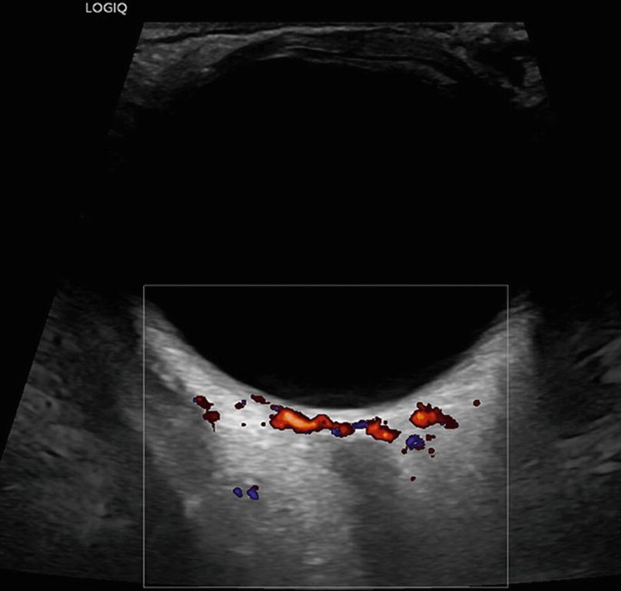 Neonatal Ultrasound: Orbits, Face, and Neck | Springer Nature Link