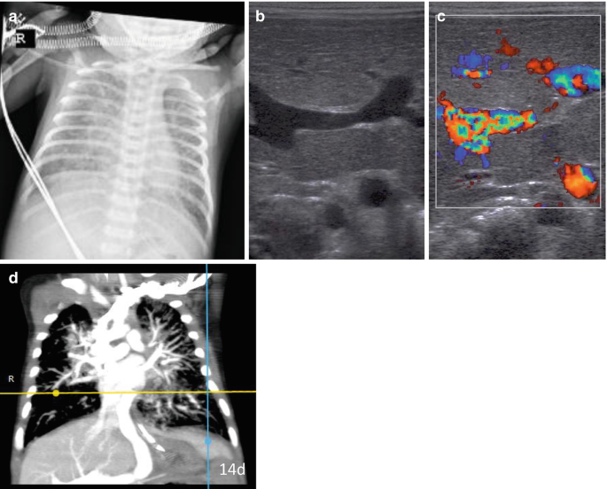 Neonatal Lungs and Mediastinum | SpringerLink