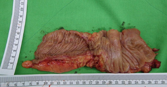 Endometriosis in Colon | SpringerLink