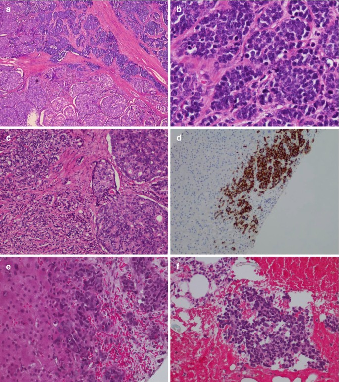 Mixed Adenocarcinoma and Small-Cell Carcinoma in the Prostate Gland ...