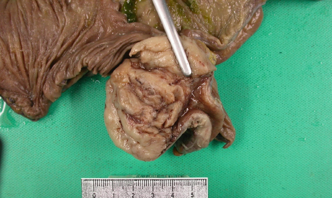 Diffuse Large B-Cell Lymphoma in Appendix | SpringerLink