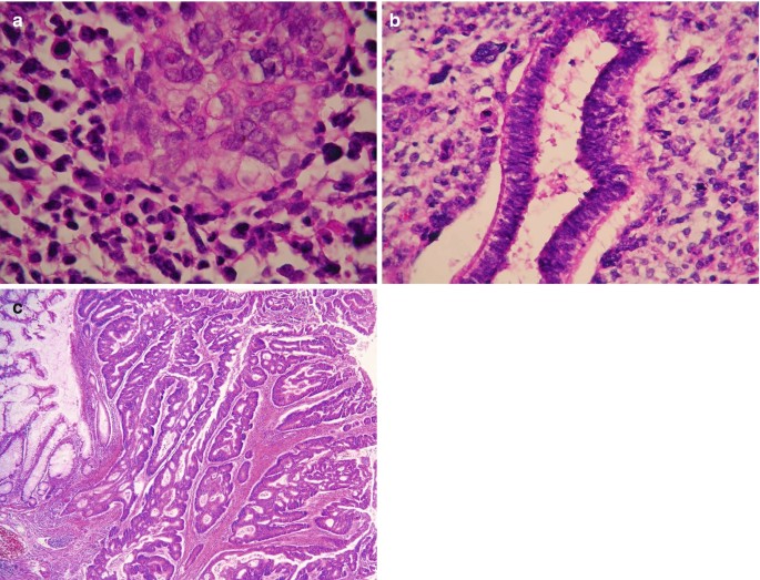 Malignant Mixed Mullerian Tumor (MMMT) in the Uterus | SpringerLink