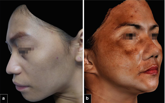Chemical Peels: Indications and Use in Various Skin Types | SpringerLink