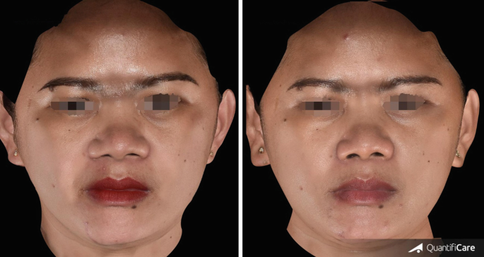Chemical Peels: Indications and Use in Various Skin Types | SpringerLink