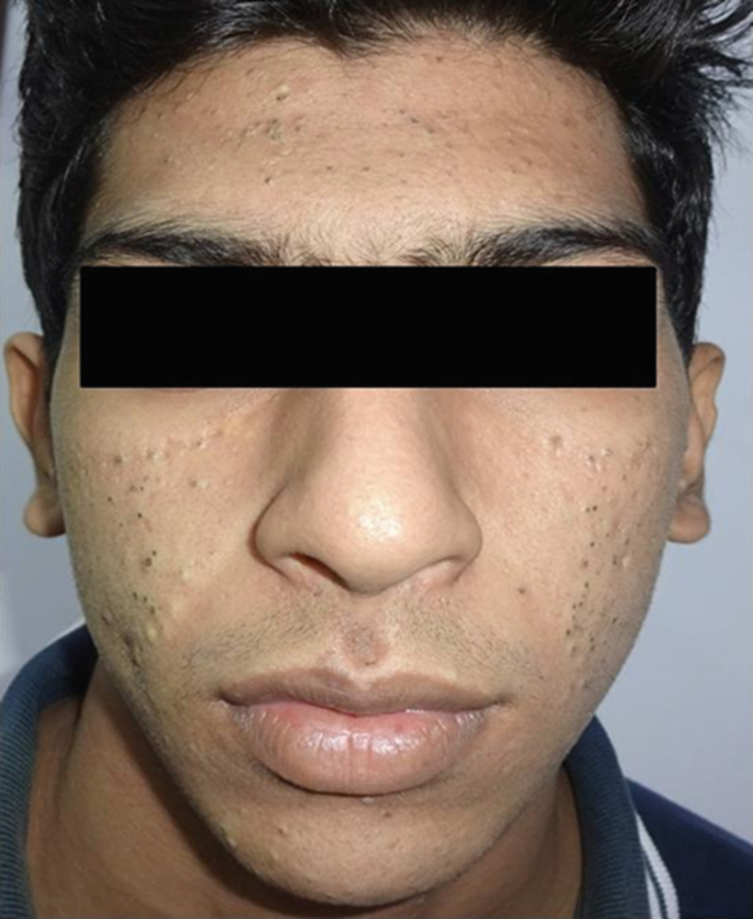 Classification of Acne and Algorithm for the Management of Acne Scars ...
