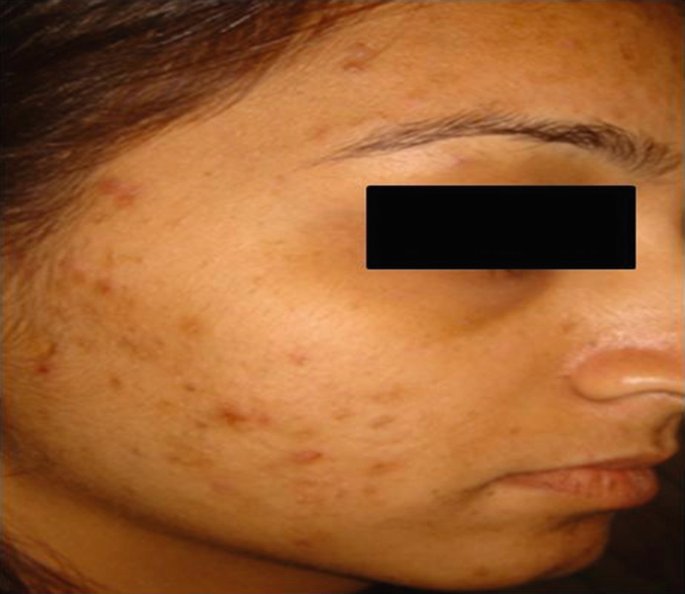 Classification of Acne and Algorithm for the Management of Acne Scars ...