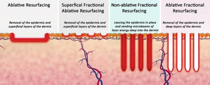 Non-ablative Laser Resurfacing of Face | Springer Nature Link (formerly ...