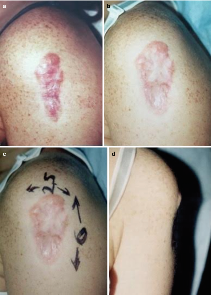 Steroid Injection Lipoatrophy: Diagnosis and Treatment | Springer ...