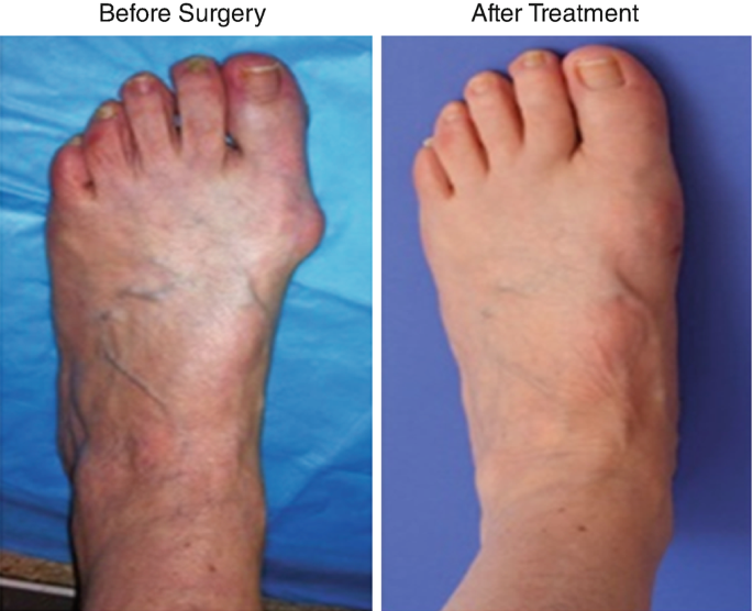 Cosmetic Surgery of the Foot-Treating Bunions and Hammertoe Deformity ...