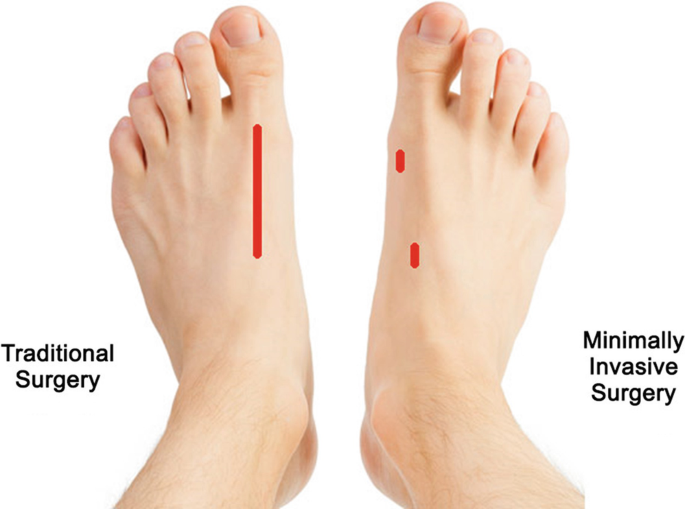 Cosmetic Surgery of the Foot-Treating Bunions and Hammertoe Deformity ...