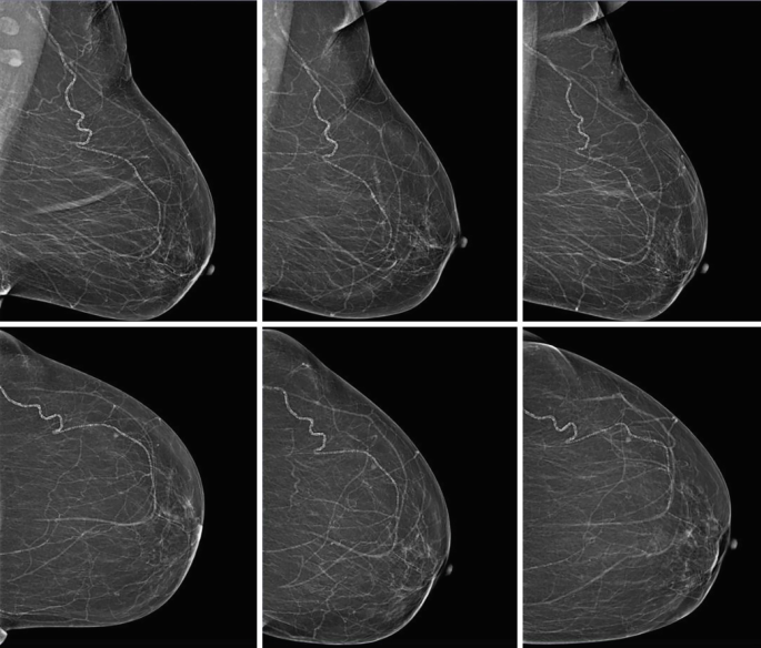 Mammography and Advances | SpringerLink