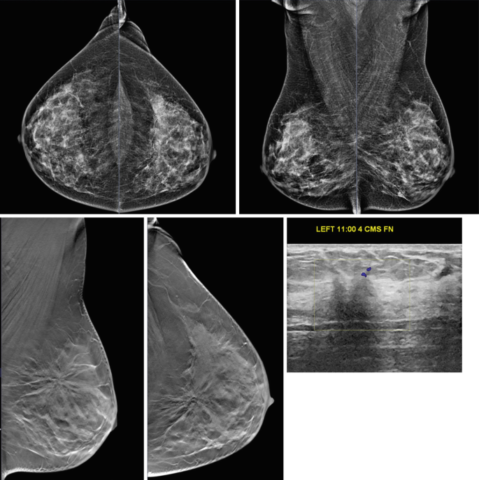 Mammography and Advances | SpringerLink