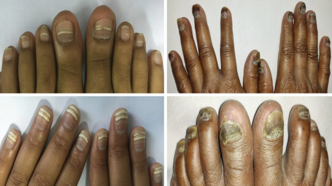 Cutaneous Manifestation of Chemotherapeutic Agents | SpringerLink