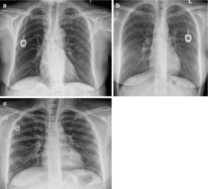 Chemoport (TIVADs—Totally Implantable Venous Access Devices ...