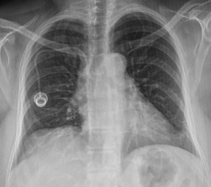 Chemoport (TIVADs—Totally Implantable Venous Access Devices ...