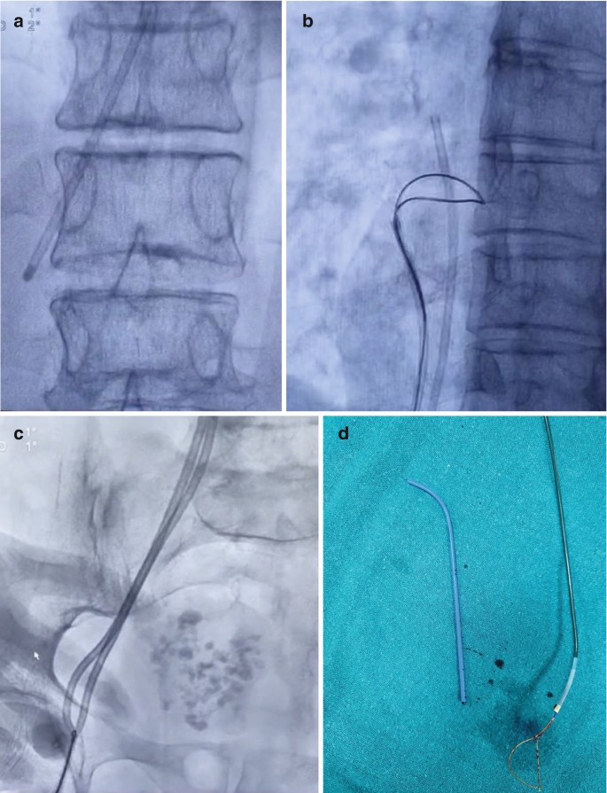 Chemoport (TIVADs—Totally Implantable Venous Access Devices ...