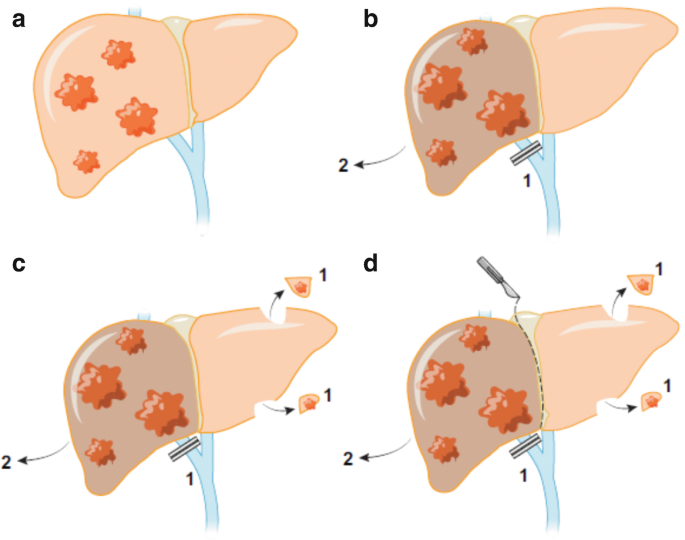 Post-operative Liver Failure in Hepatic Resections | SpringerLink