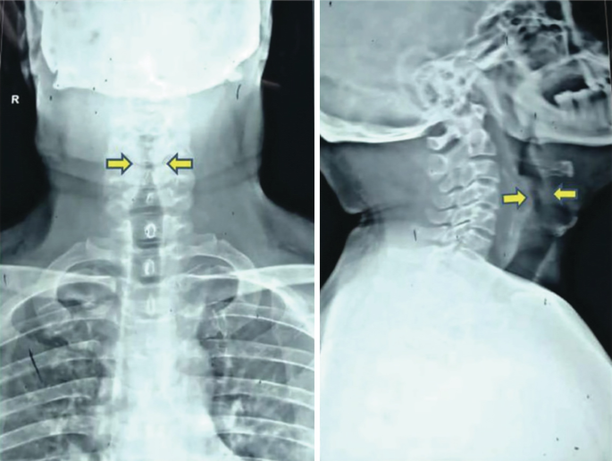 Anaesthesia Related Implications and Complications in Cancer Patients ...