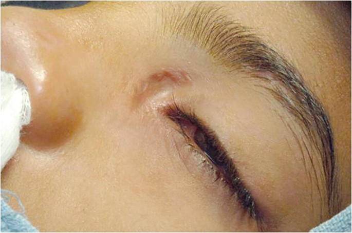 Revision External Dacryocystorhinostomy | SpringerLink