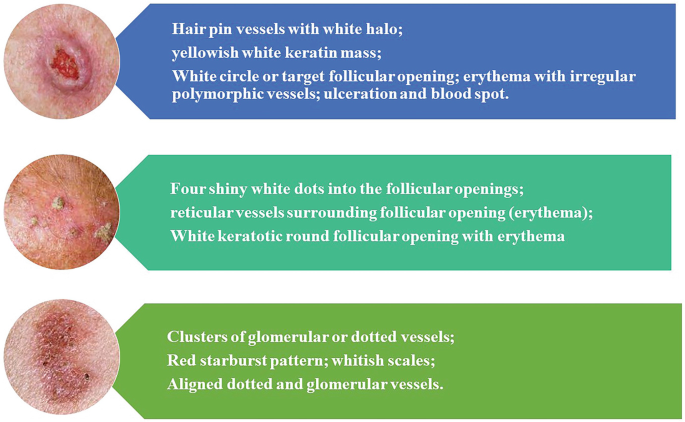 Squamous Cell Carcinoma Predisposition Pathophysiology, Diagnosis, and ...