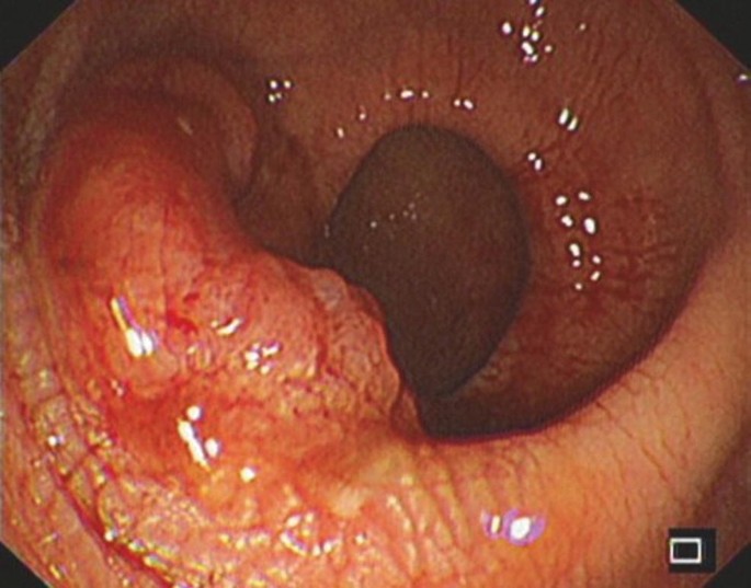Laparoscopic Rectal Cancer Resection Combined with Liver Metastasis ...