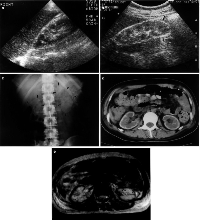 Nephrocalcinosis | SpringerLink