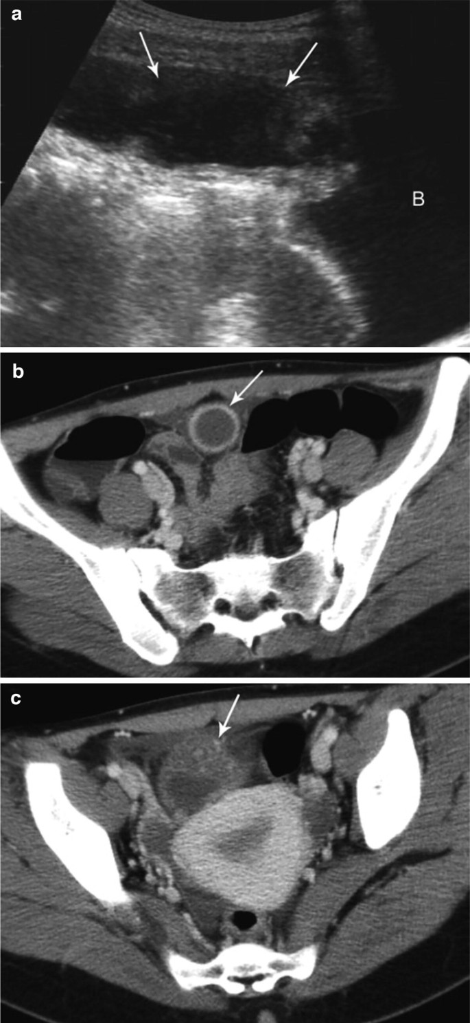 Nonneoplastic Diseases of the Urinary Bladder | Springer Nature Link ...