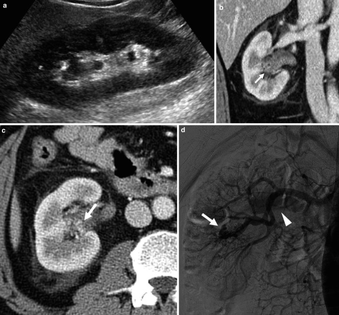 Vascular Disease of the Kidney | Springer Nature Link