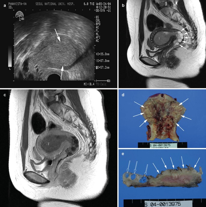 Endometrial Carcinoma | Springer Nature Link