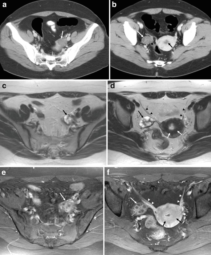 Gynecologic CT and MR Imaging: Techniques and Normal Findings ...