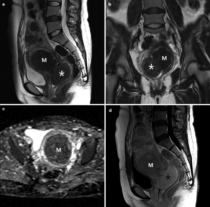 Uterine Myoma | Springer Nature Link (formerly SpringerLink)