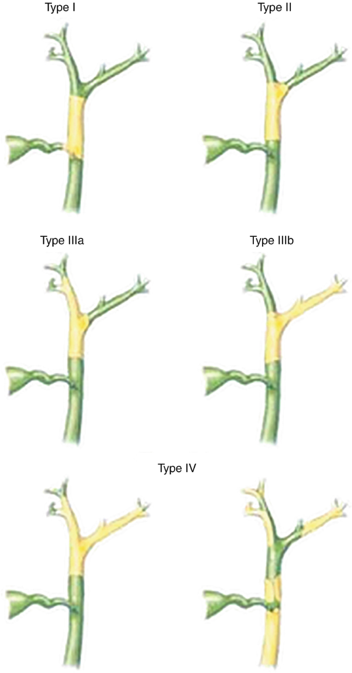 Biliary Tract Cancer | SpringerLink