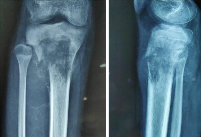 Bone Tumors: An Overview | SpringerLink