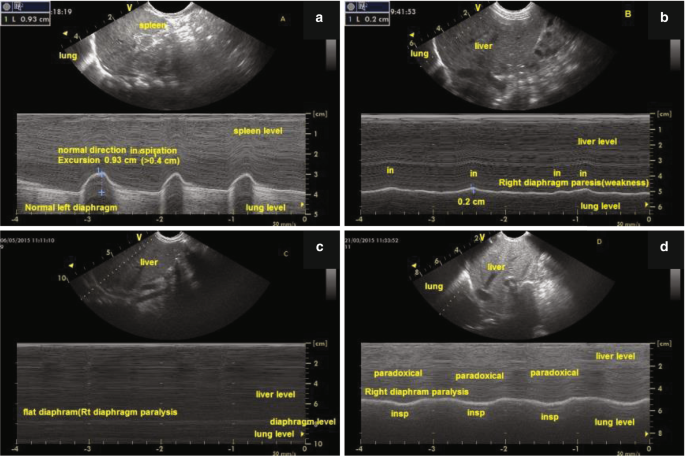Guideline for Ultrasound Evaluation for Diaphragmatic Dysfunction in ...