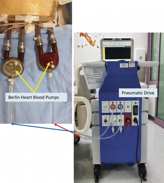 Mechanical Circulatory Support in Pediatric Cardiac Critical Care ...