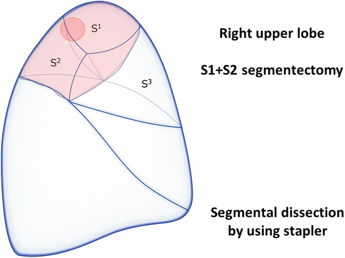 Right S1 And S2 Double Segmentectomy By Only Using Stapler Springerlink