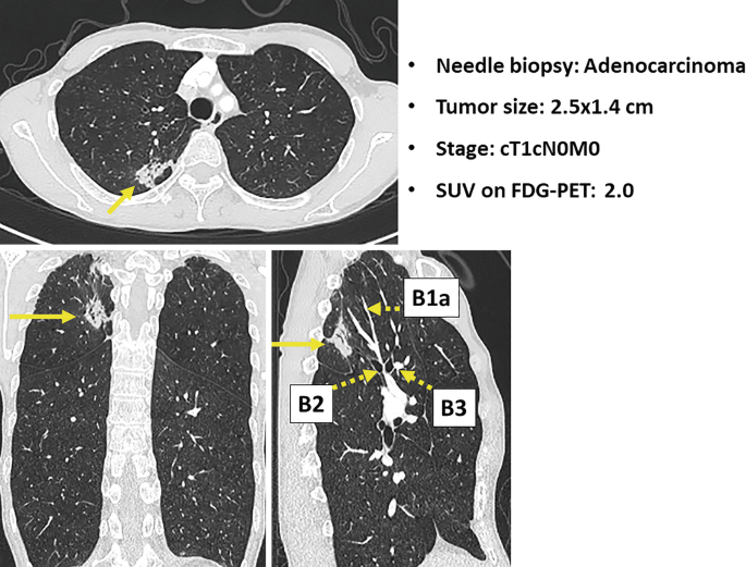 Right S1 and S2 Double Segmentectomy by only Using Stapler | SpringerLink