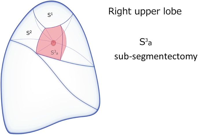 Right S3a Sub-segmentectomy for Primary Lung Cancer | SpringerLink