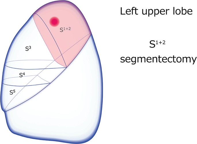 Left S1 2 Segmentectomy By Using Electrocautery Springerlink