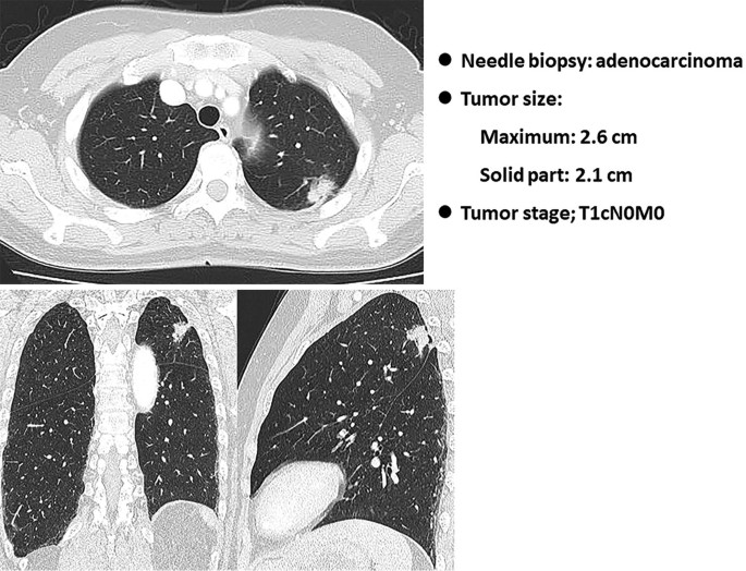 Left S1 + 2 Segmentectomy by Using Electrocautery | SpringerLink
