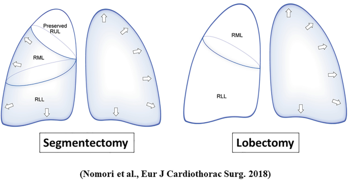 Pulmonary Function After Segmentectomy Springerlink