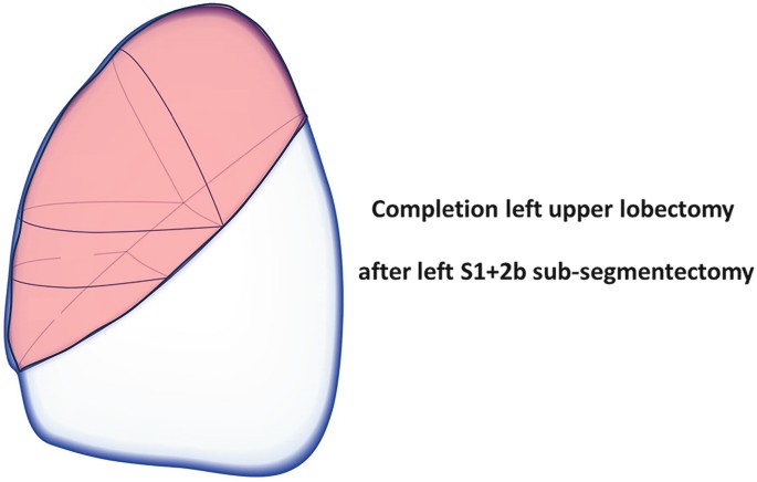 Completion Lobectomy of Left Upper Lobe for Margin Recurrence After S1 + 2b Sub-segmentectomy ...