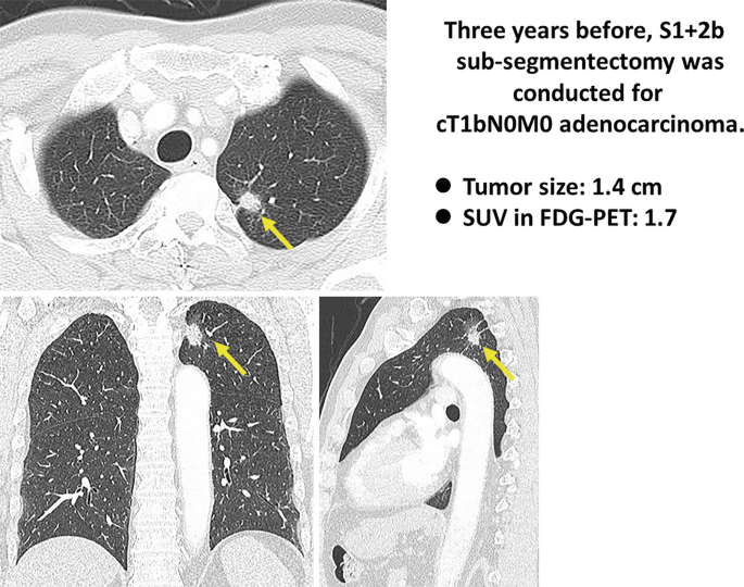 Completion Lobectomy of Left Upper Lobe for Margin Recurrence After S1 ...