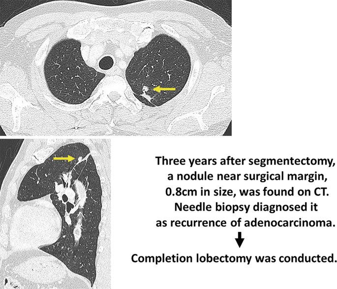 Completion Lobectomy of Left Upper Lobe for Margin Recurrence After S1 + 2b Sub-segmentectomy ...