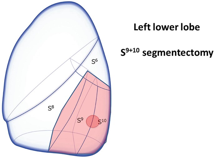 Left S9 and 10 Double Segmentectomy | SpringerLink
