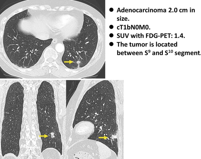 Left S9 and 10 Double Segmentectomy | SpringerLink