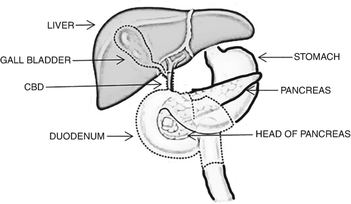 Periampullary Carcinoma for Whipple’s Procedure | SpringerLink